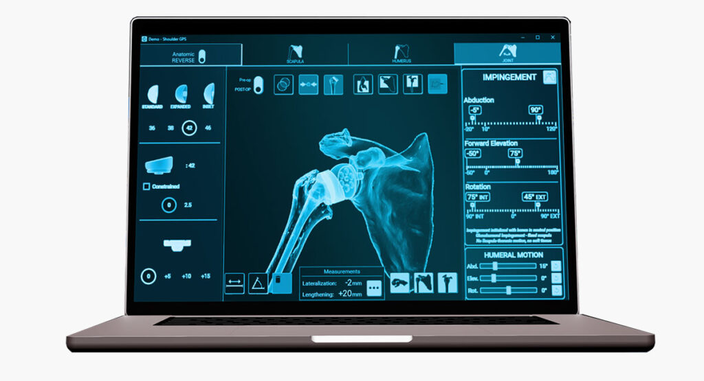 PAGE epaule- Exactech GPS - Exactech.fr